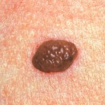 Rak kože: Znakovi za koje morate znati!