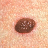 Rak kože: Znakovi za koje morate znati!